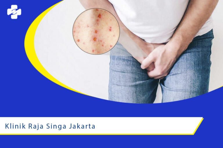 Mengenal Penyakit Menular Seksual Raja Singa